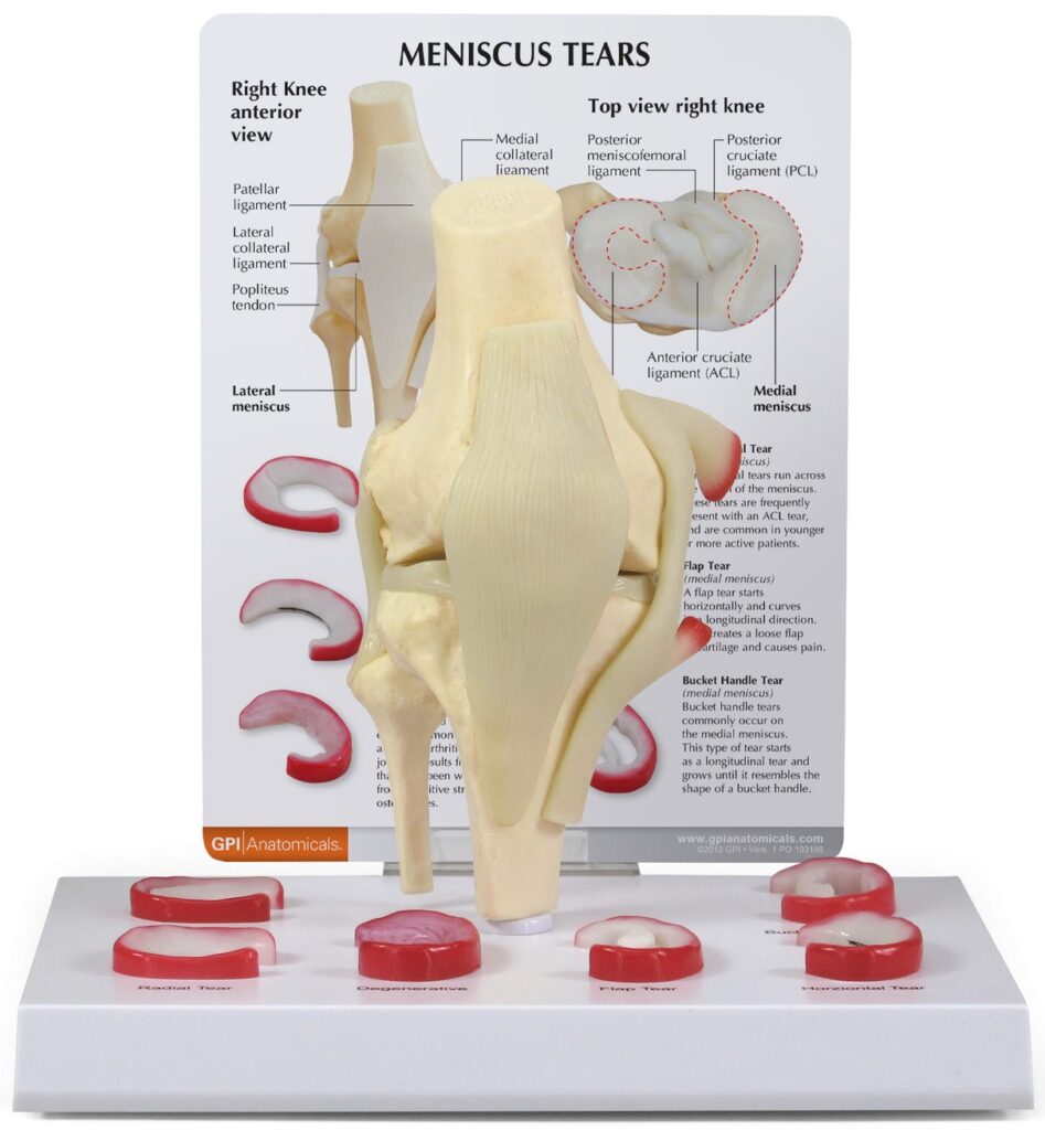 Modelo Anatómico de Rotura de Menisco en la Rodilla – Medical Factory