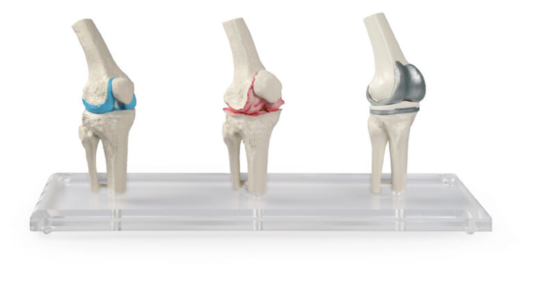 Modelo de Implante de Rodilla - Medical Factory