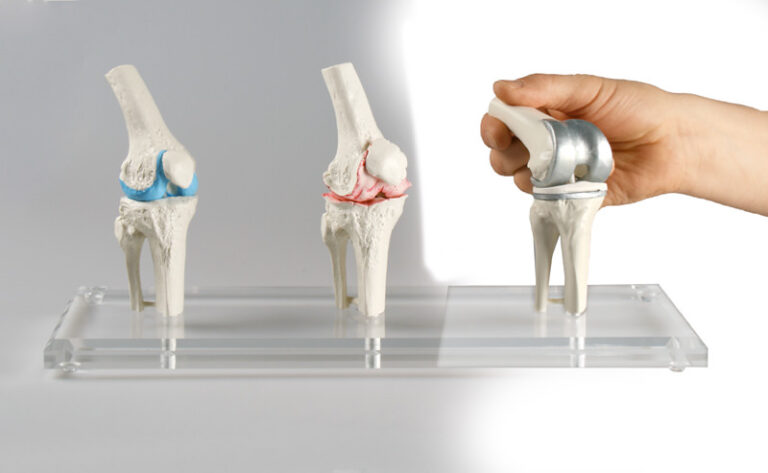 Modelo de Implante de Rodilla - Medical Factory